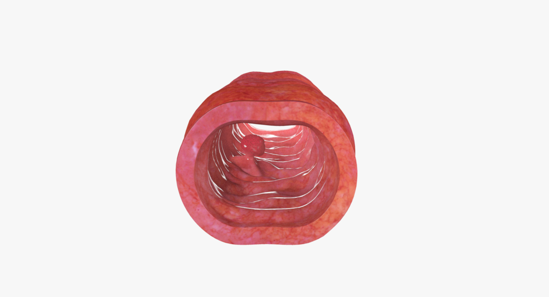 Polyp Digestive 3d Model