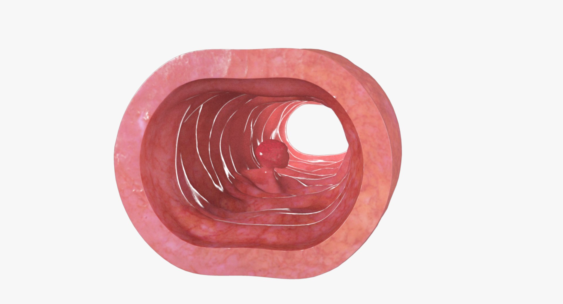 Polyp Digestive 3d Model