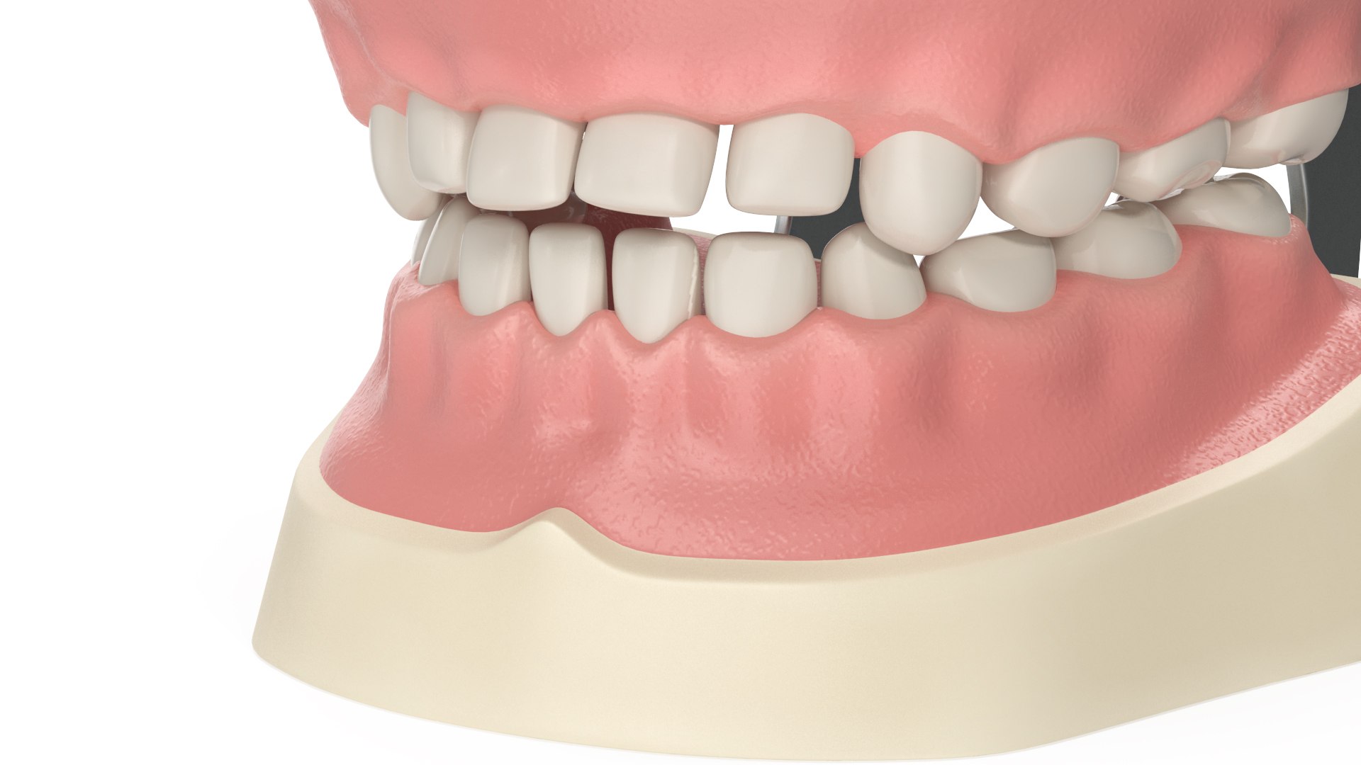 Dental Anatomy Educational Pediatric Kit With Removable Open Bite Teeth ...