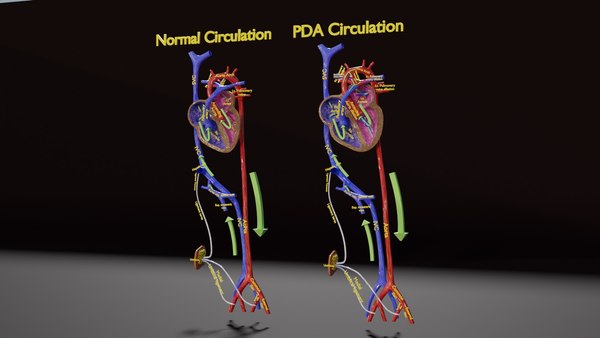 modelo 3d PDA Ductus arterioso persistente vs circulación sanguínea ...