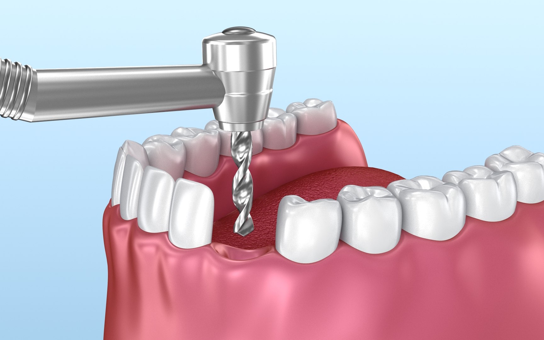 Dental implant instalation animation 3D model - TurboSquid 1463471
