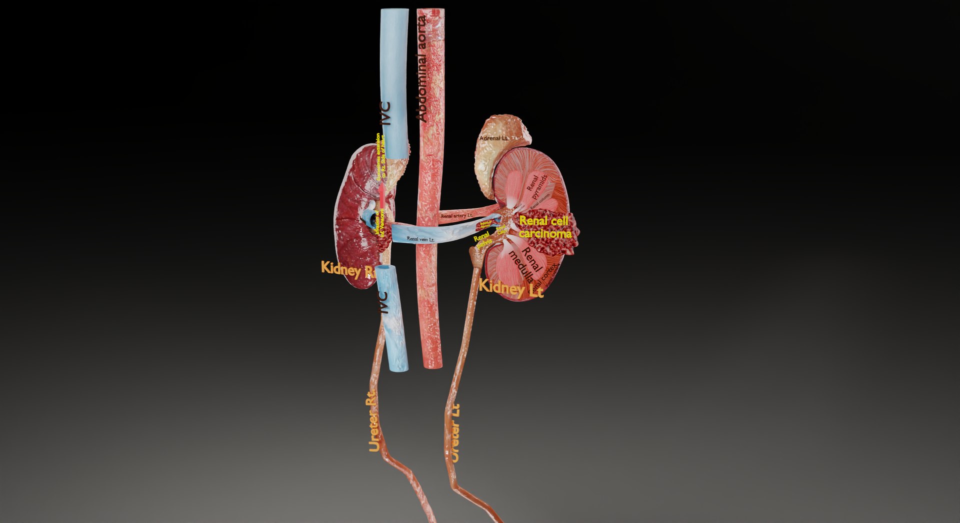 Renal Cell Carcinoma 3D Model - TurboSquid 1980618