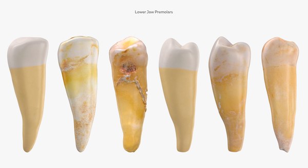 modelo 3d Colección de dientes limpios y dañados de premolares humanos ...