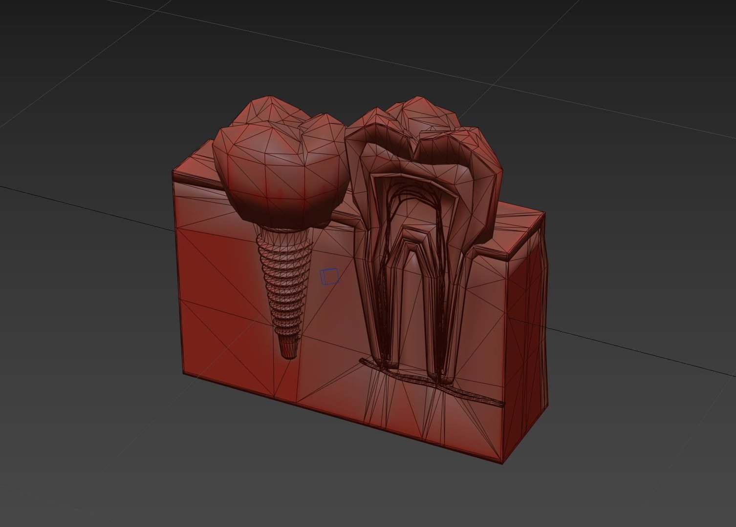 3D Dental Implants Teeth Model - TurboSquid 1544104