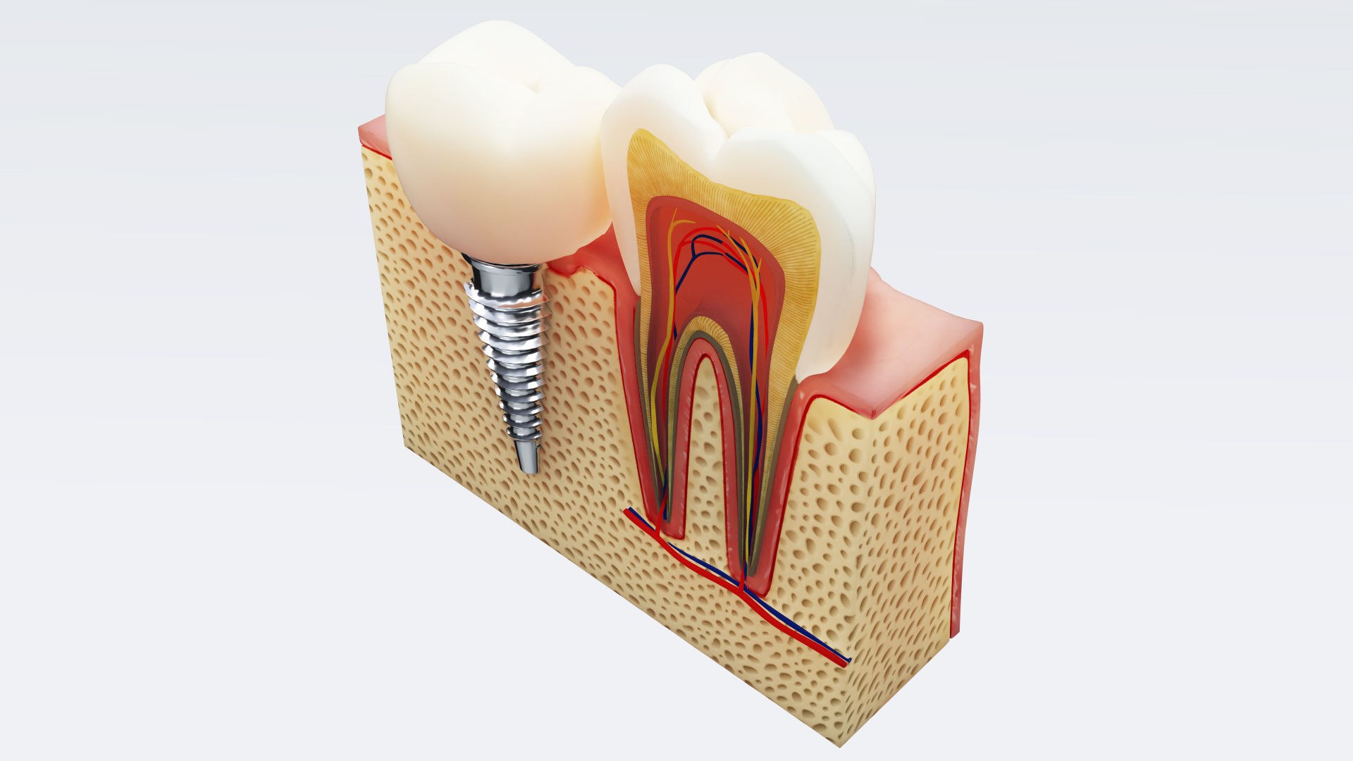 3D Dental Implants Teeth Model - TurboSquid 1544104