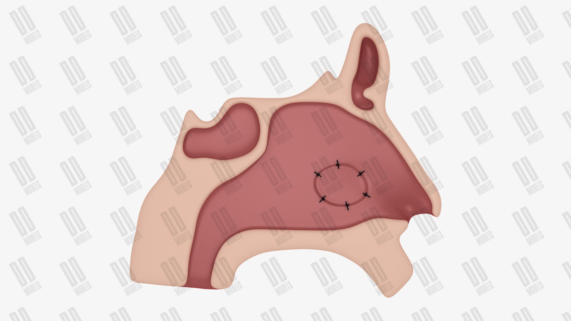 3D Septal Perforation Model - TurboSquid 1678640
