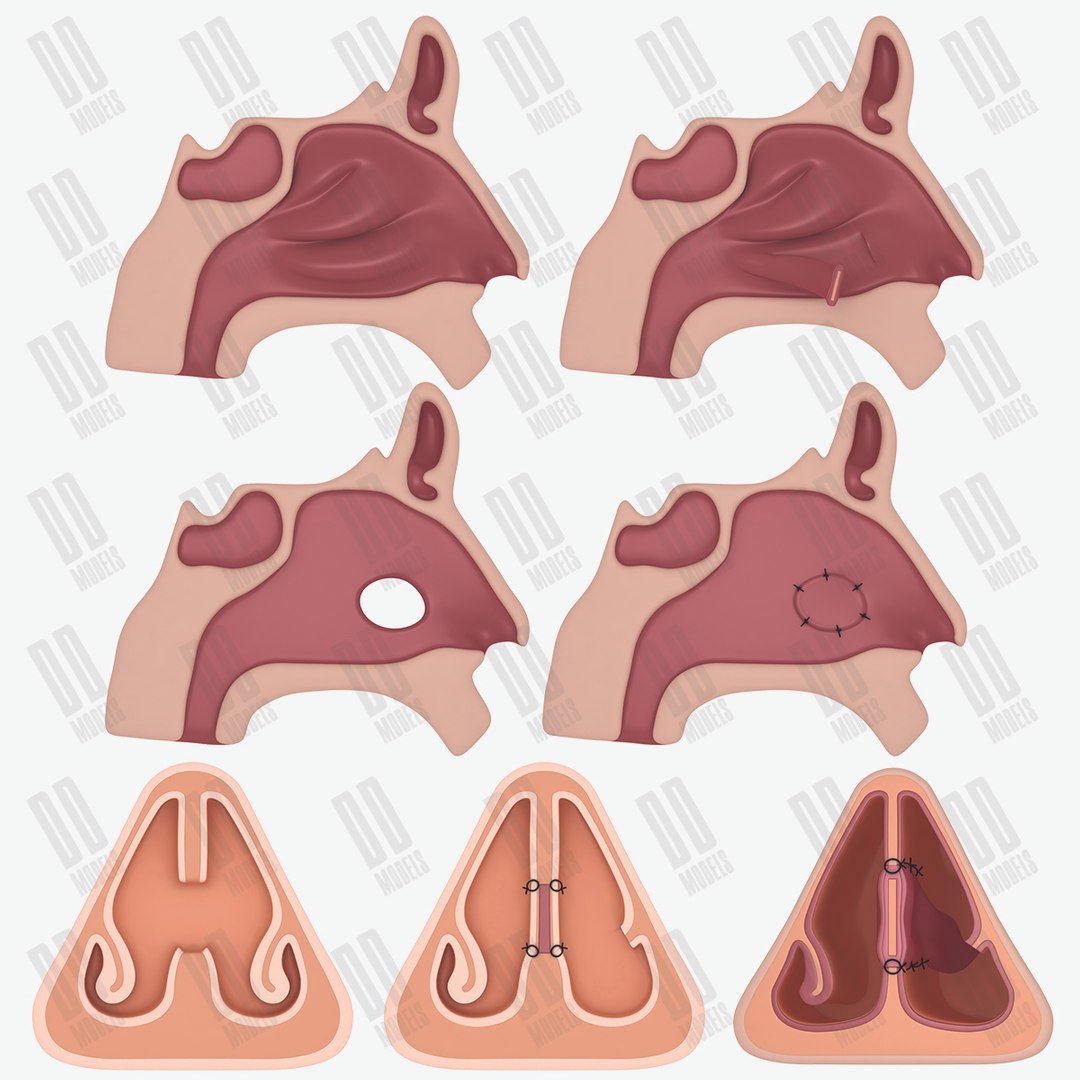 3D Septal Perforation Model - TurboSquid 1678640