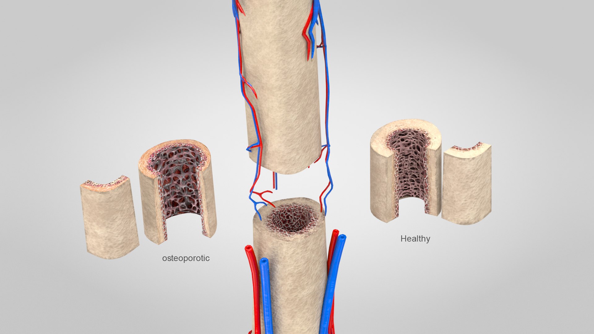 Inside Bone With Healthy And Osteoporotic Section Model - TurboSquid ...