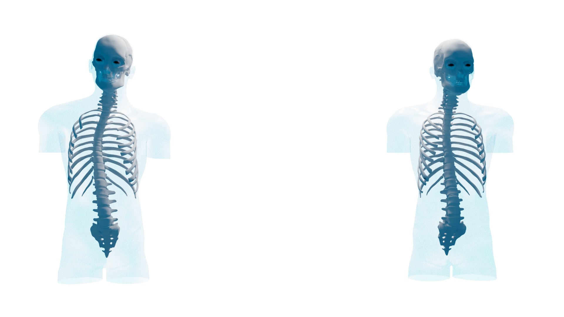 3D Scoliosis Skeleton Vs Normal Skeleton - TurboSquid 2128868