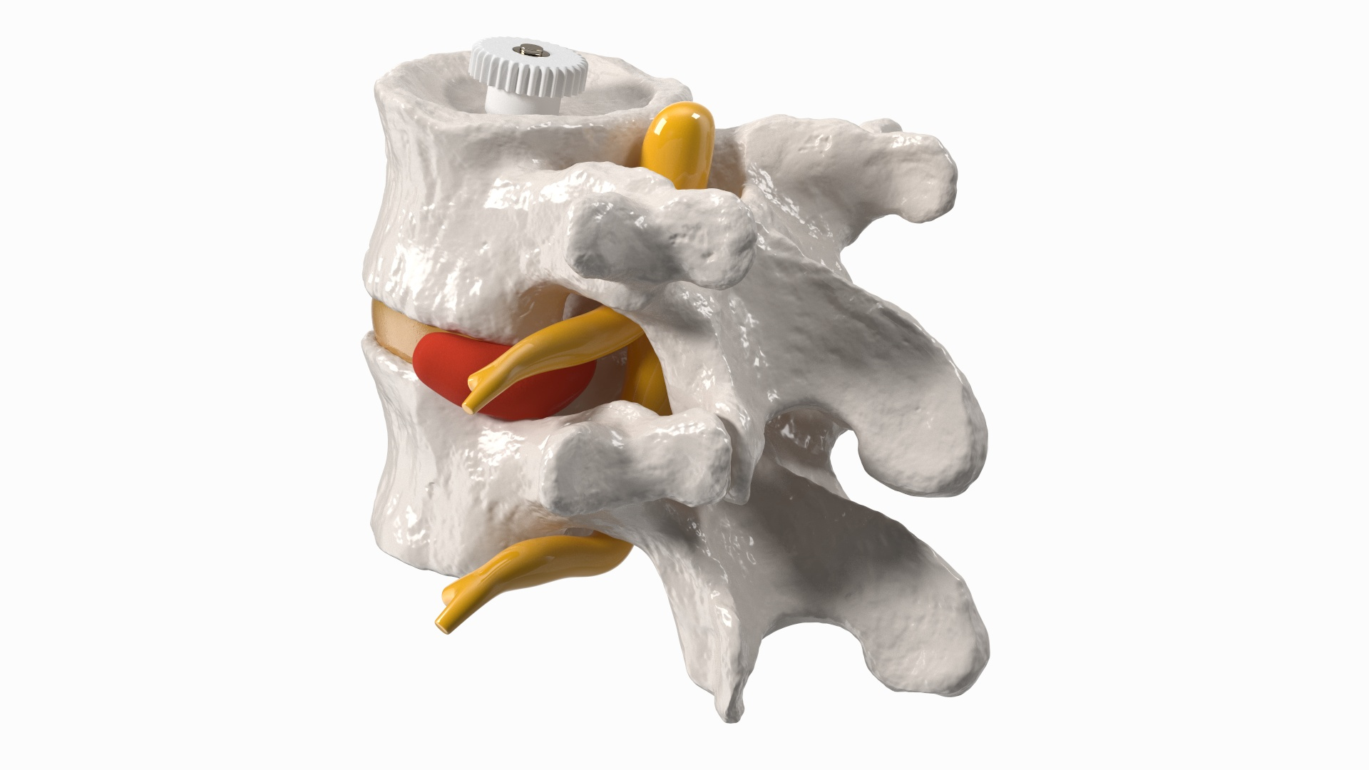3D Part Of Spinal Column With Hernia Model - TurboSquid 2047604