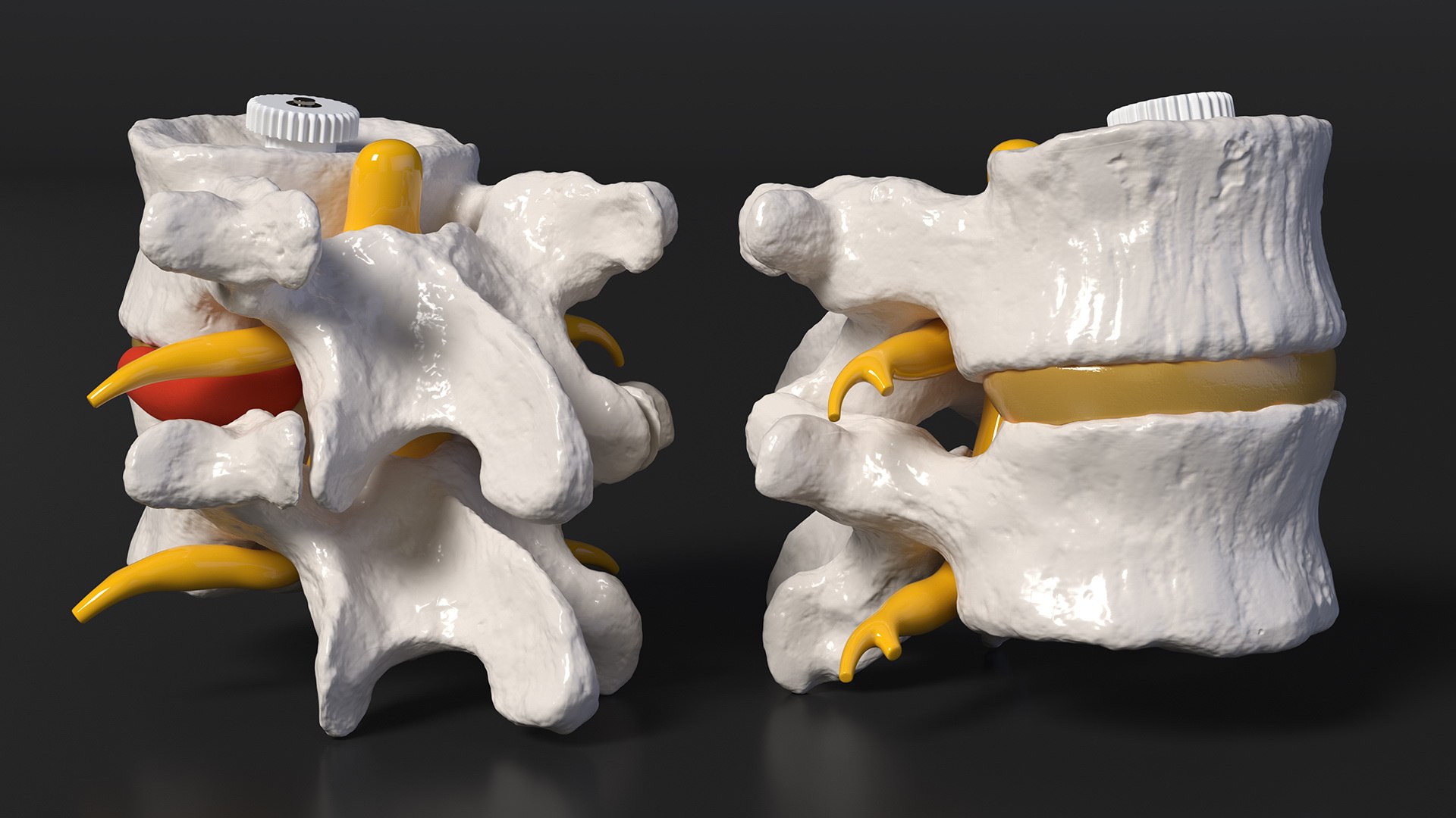 3D Part Of Spinal Column With Hernia Model - TurboSquid 2047604