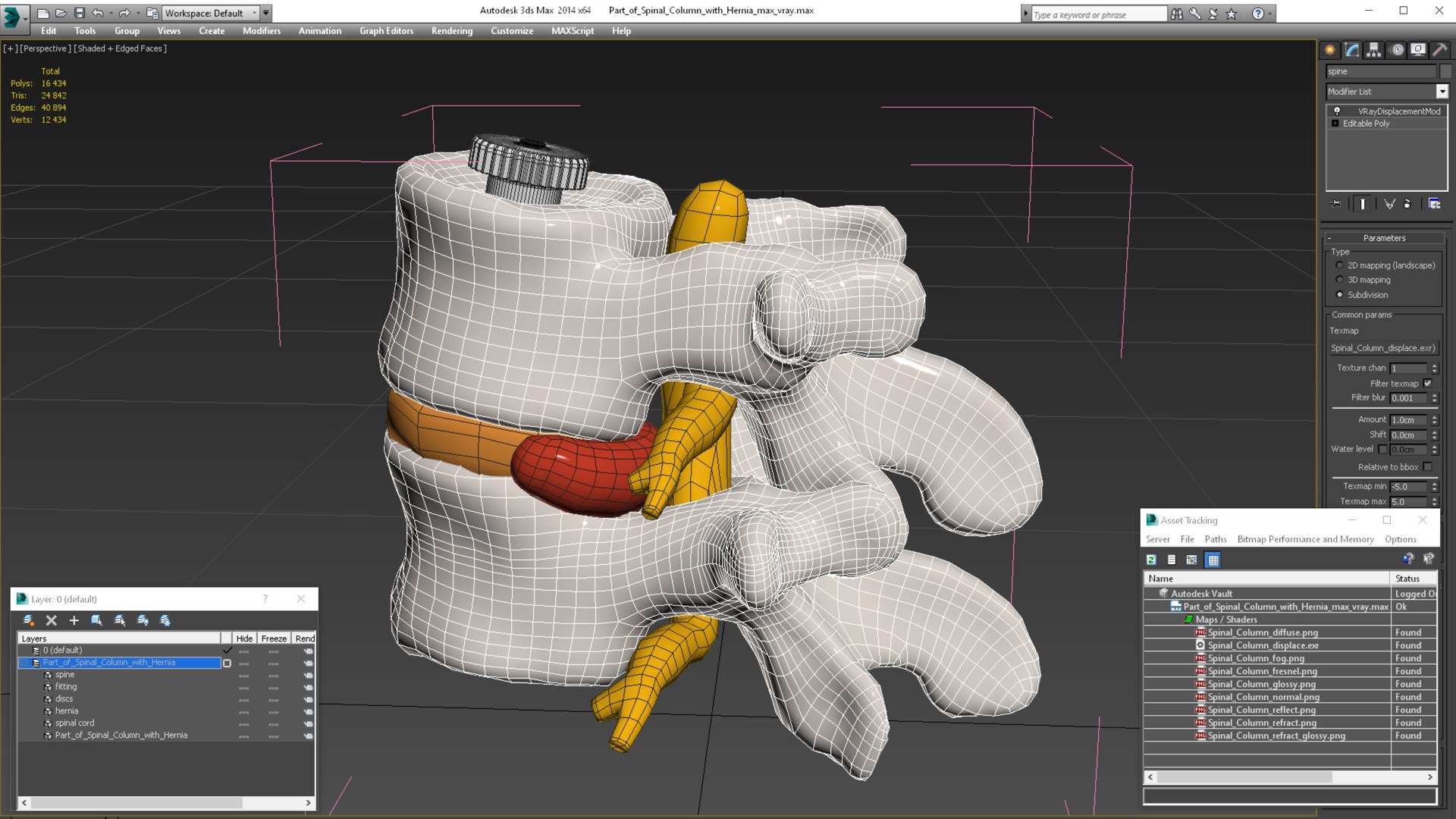 3D Part of Spinal Column with Hernia model - TurboSquid 2047604