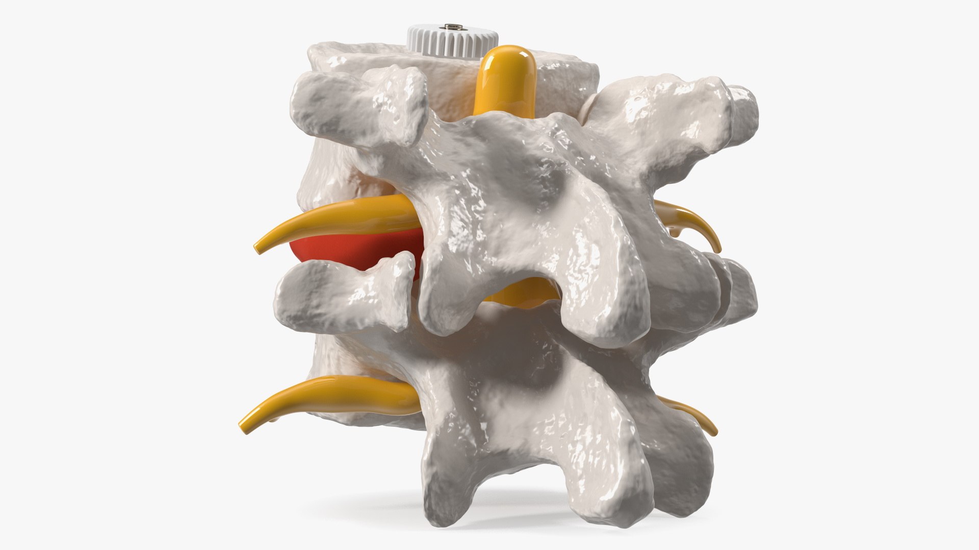 3D Part Of Spinal Column With Hernia Model - TurboSquid 2047604