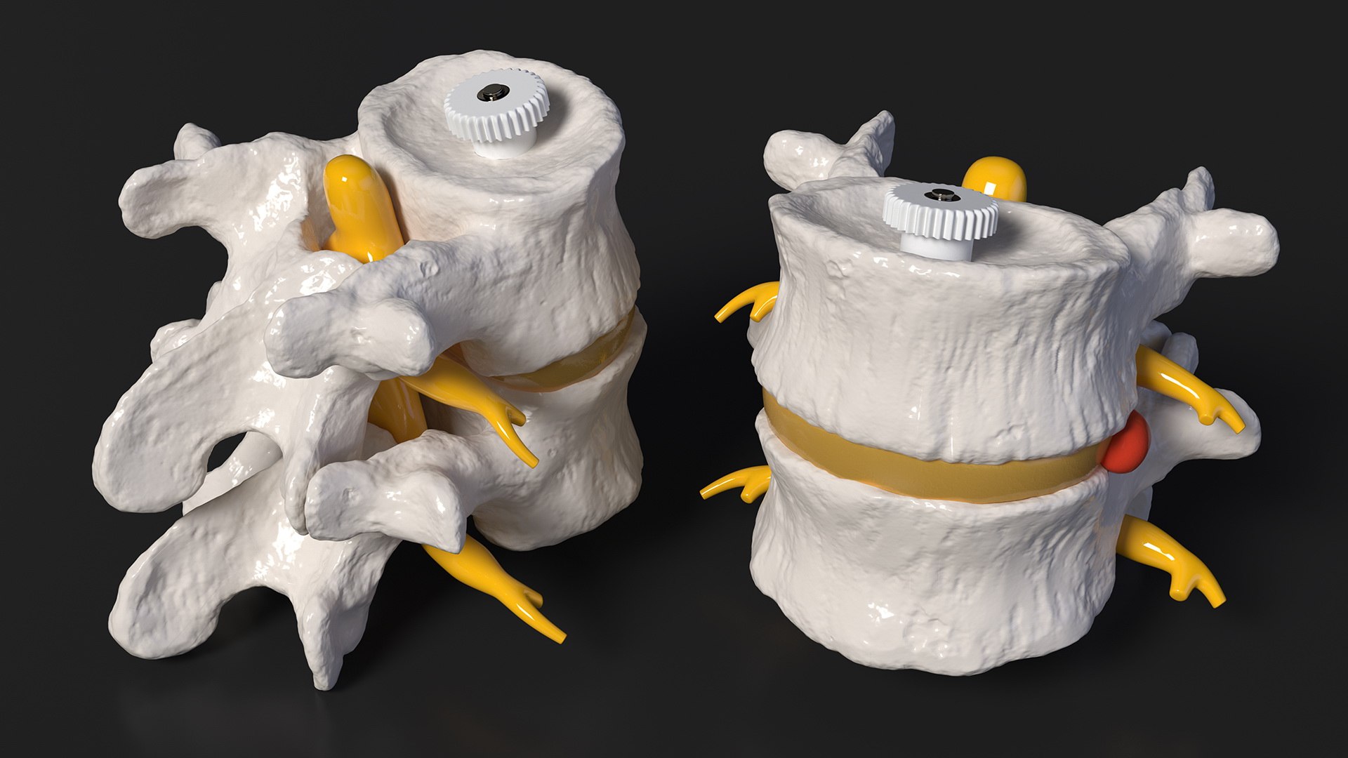 3D Part Of Spinal Column With Hernia Model - TurboSquid 2047604