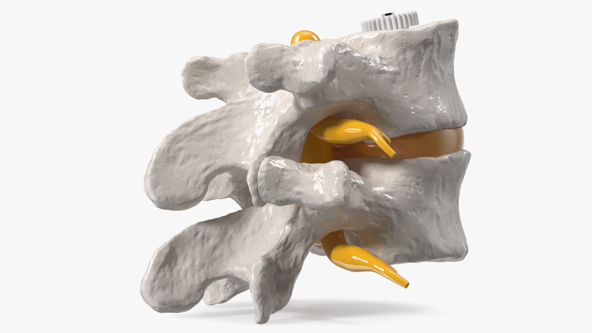 3D Part Of Spinal Column With Hernia Model - TurboSquid 2047604