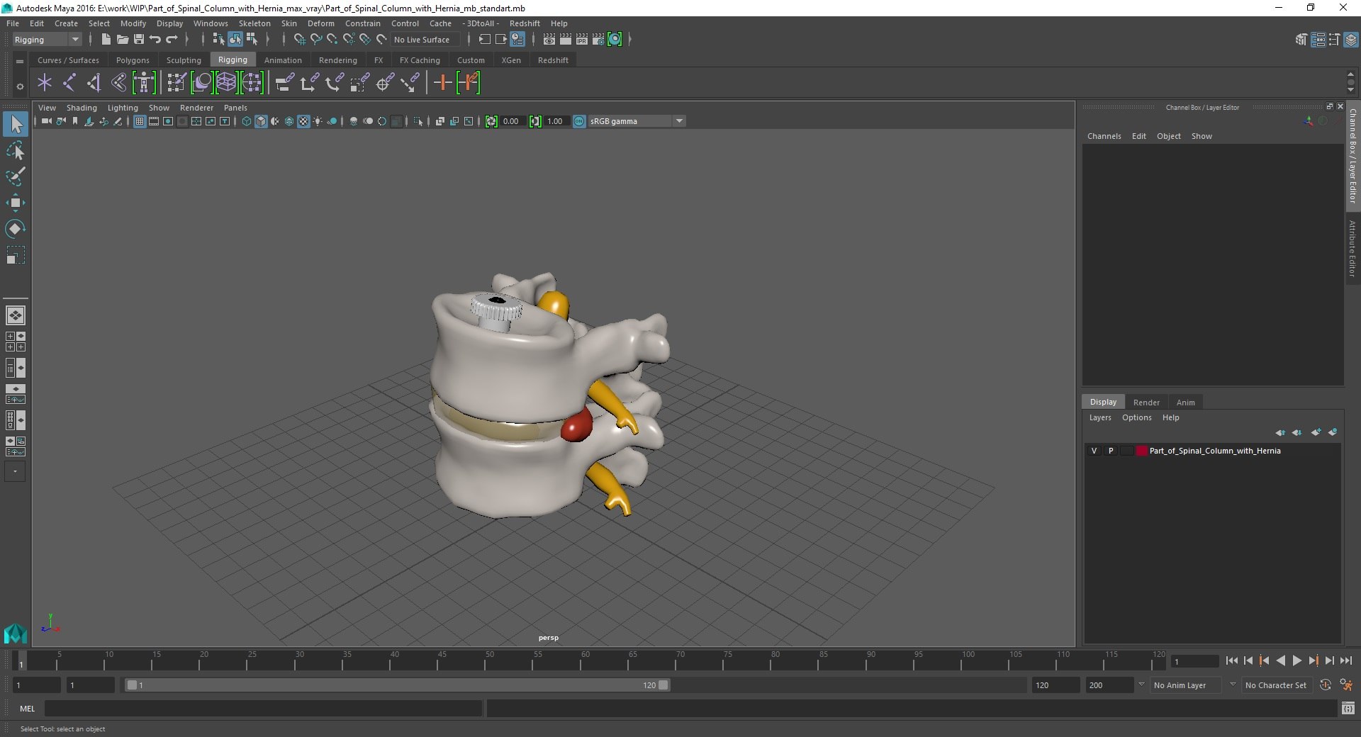 3D Part of Spinal Column with Hernia model - TurboSquid 2047604
