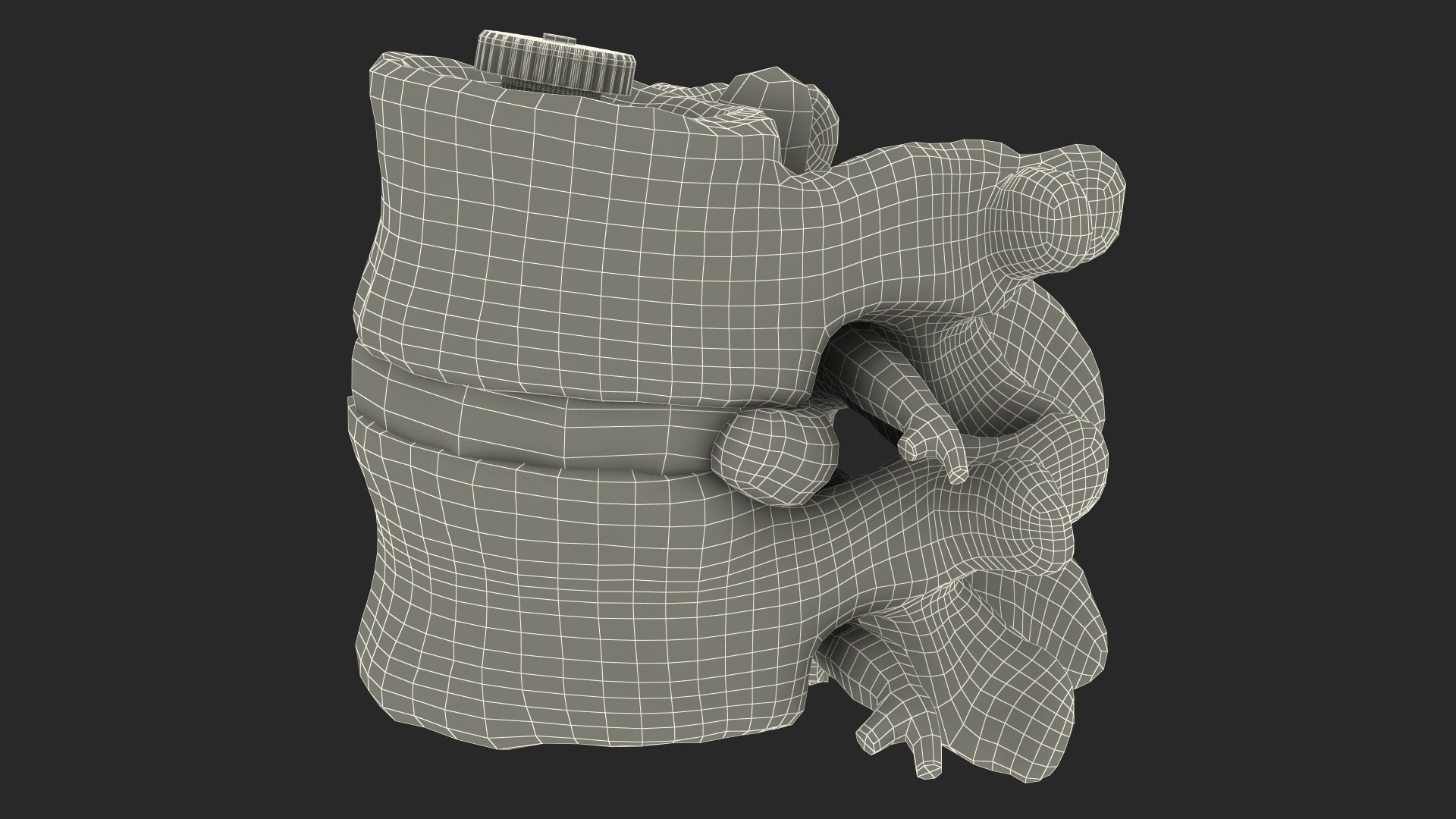 3D Part Of Spinal Column With Hernia Model - TurboSquid 2047604