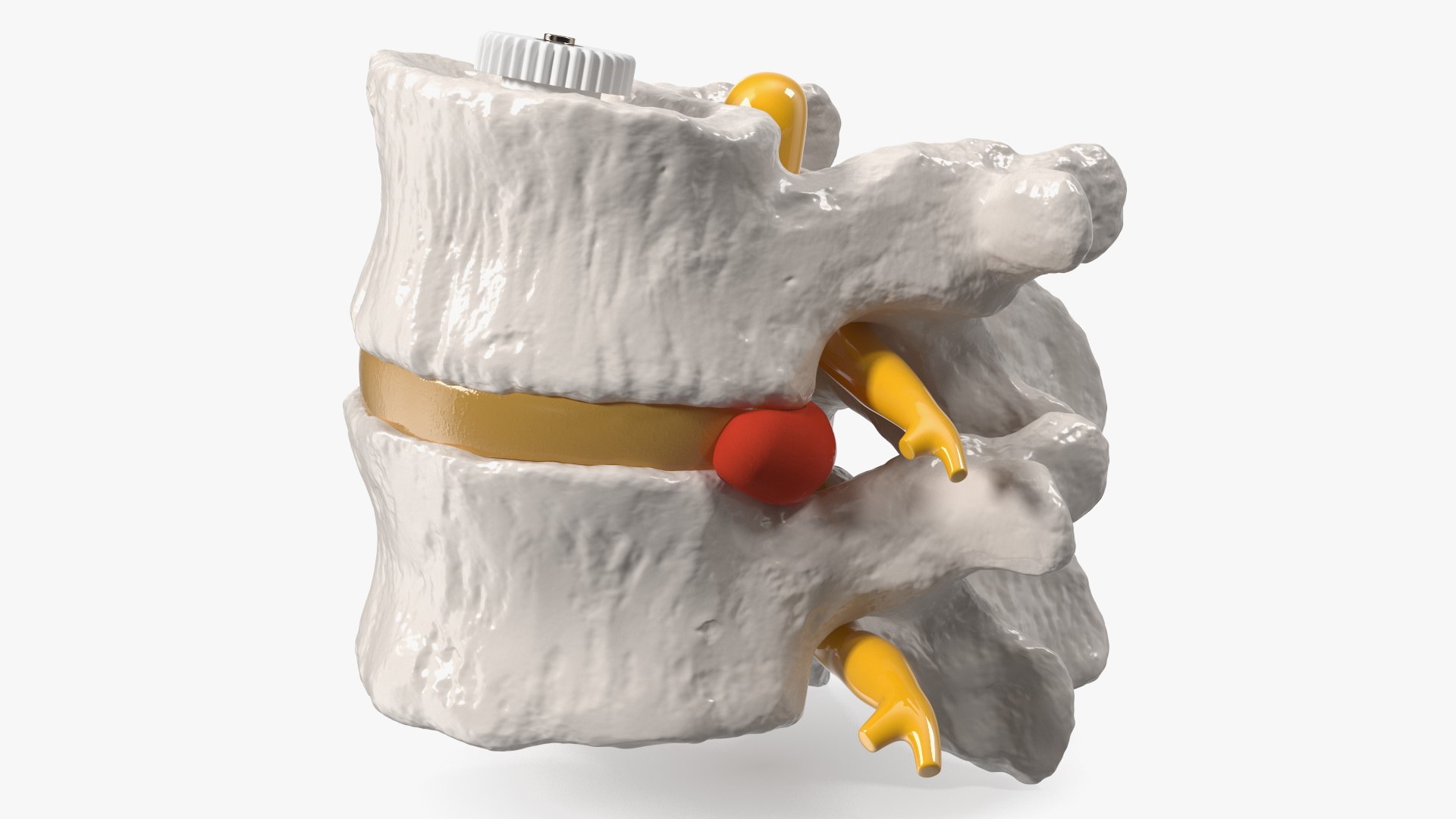 3D Part Of Spinal Column With Hernia Model - TurboSquid 2047604