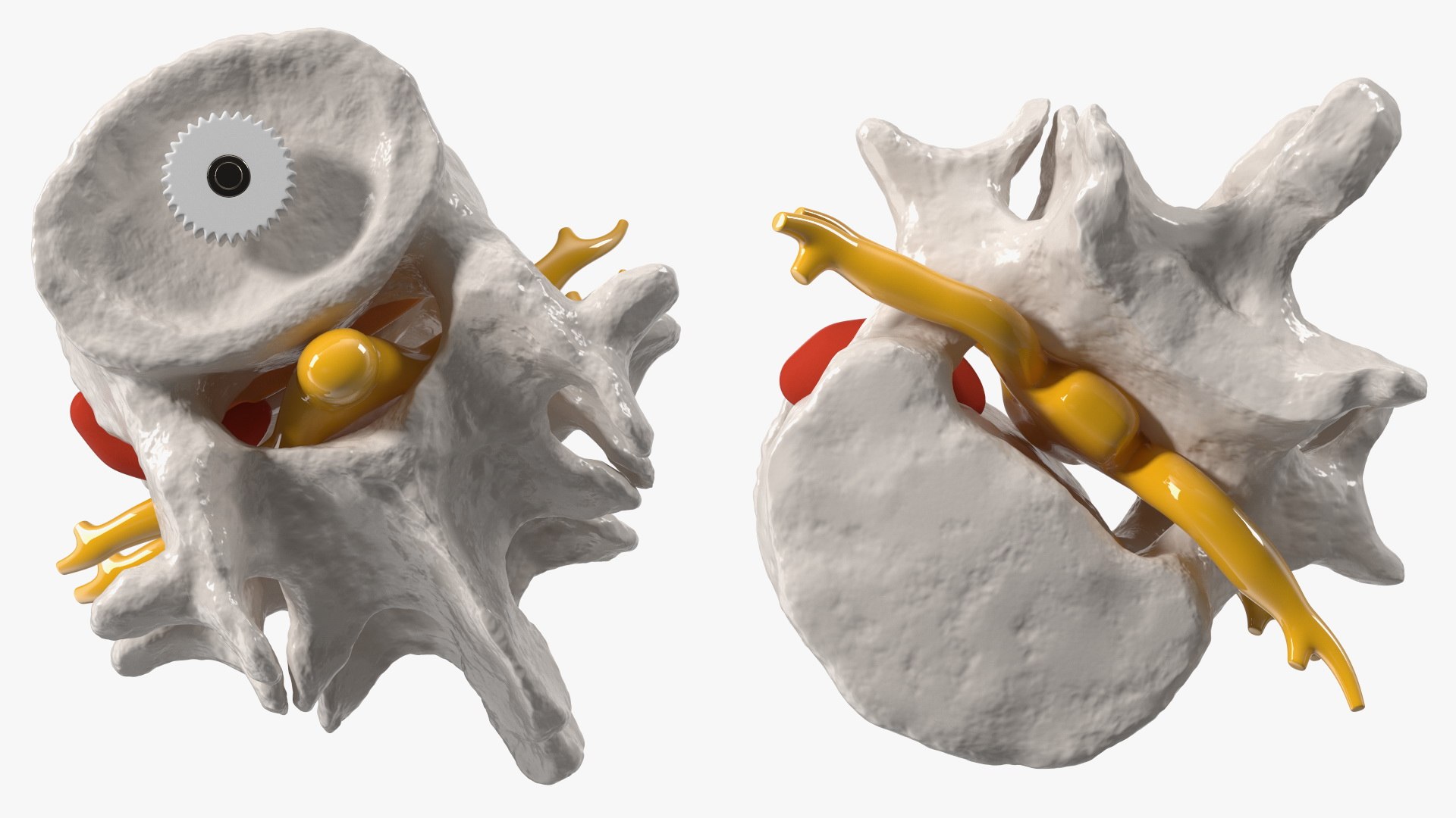 3D Part Of Spinal Column With Hernia Model - TurboSquid 2047604
