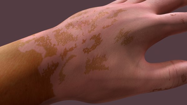 modelo 3d Vitiligo Leucoderma enfermedad de la piel - TurboSquid 2184626