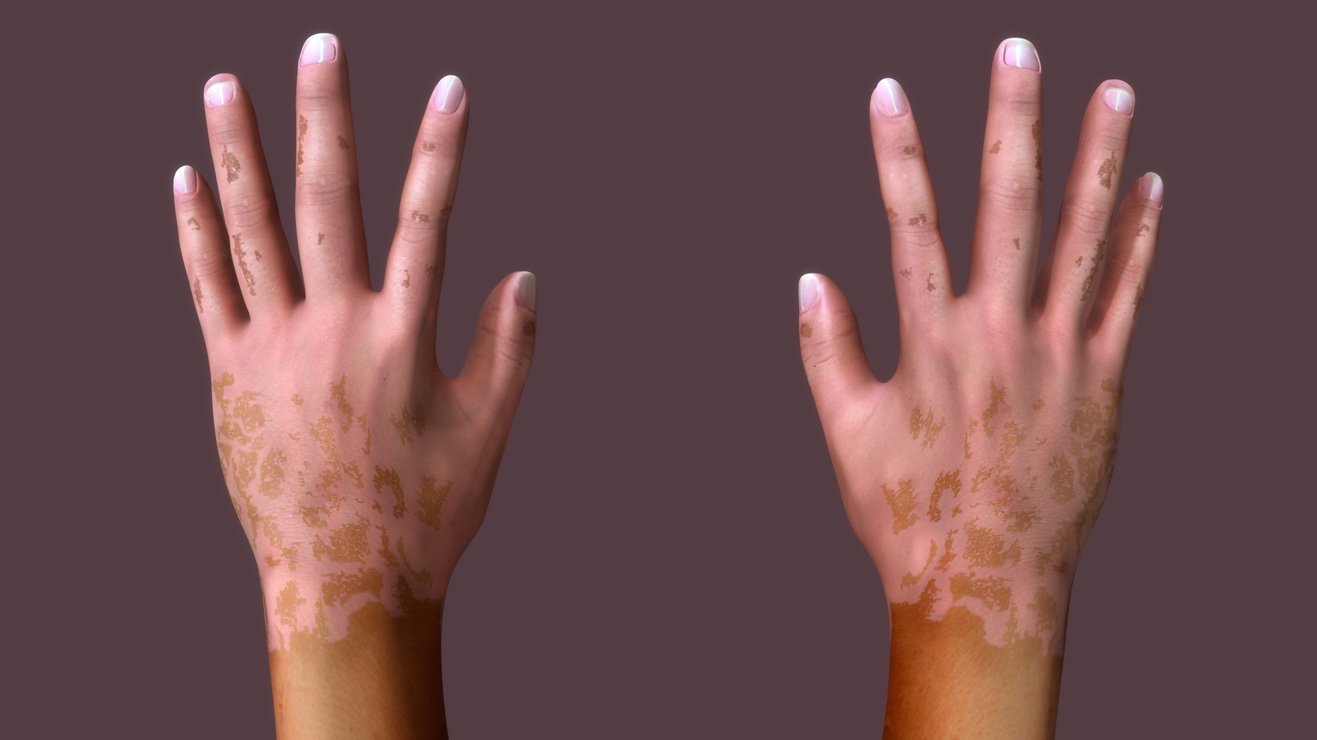 3D Vitiligo Leucoderma Skin Disease - TurboSquid 2184626