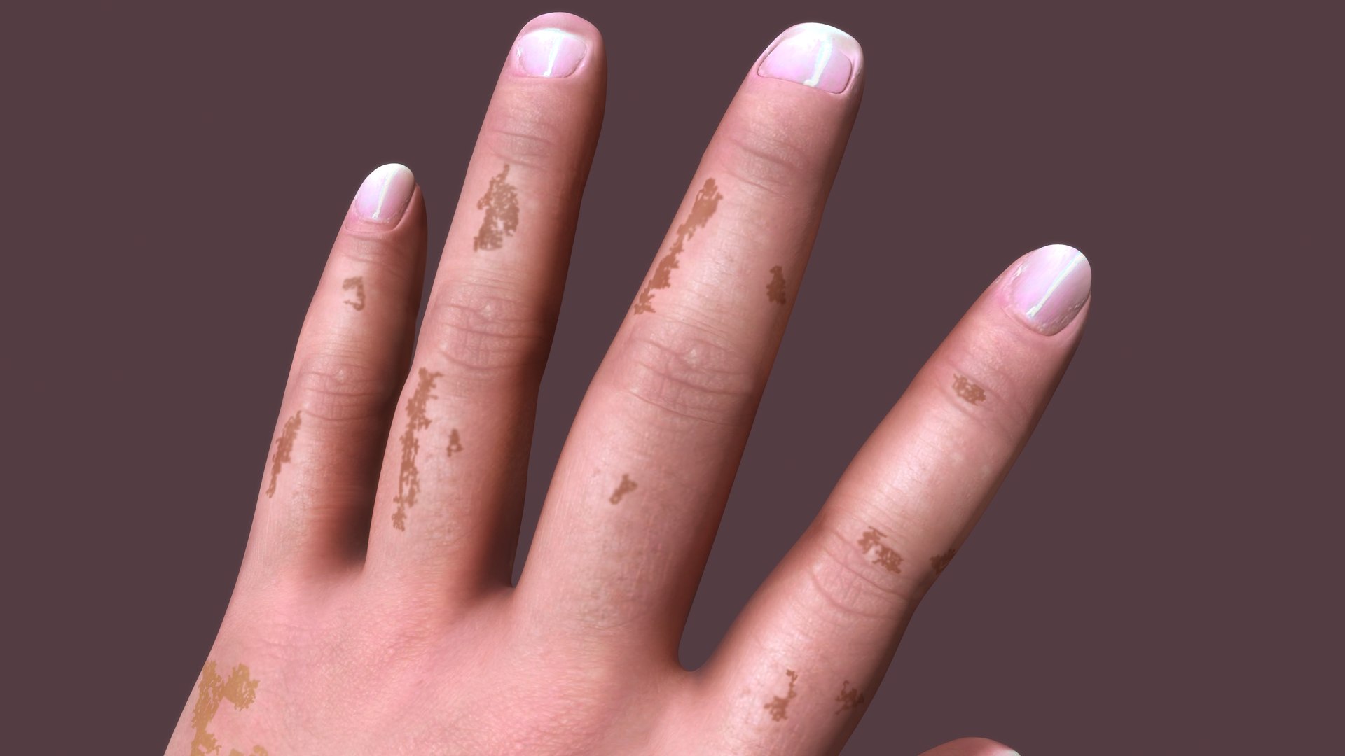 3D Vitiligo Leucoderma Skin Disease - TurboSquid 2184626