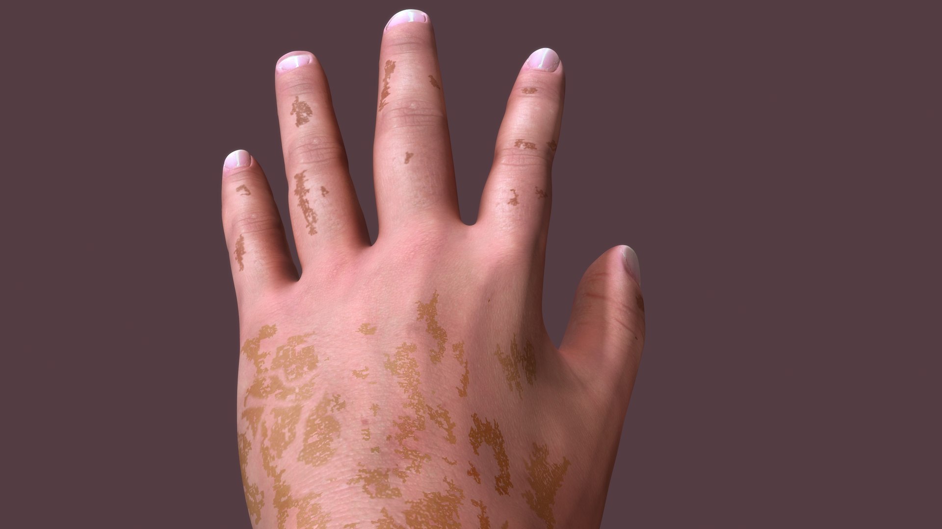 3D Vitiligo Leucoderma Skin Disease - TurboSquid 2184626