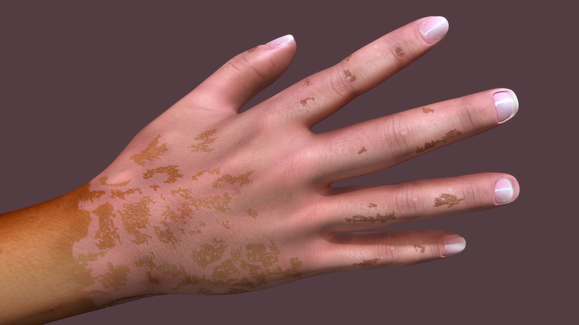 3D Vitiligo Leucoderma Skin Disease - TurboSquid 2184626