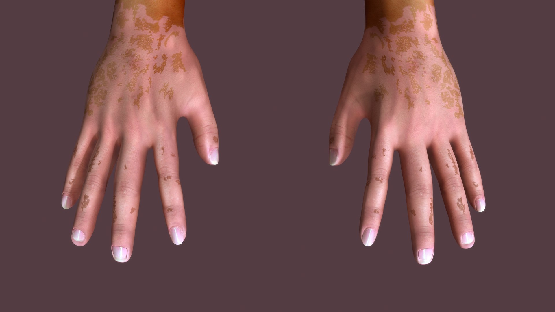 3D Vitiligo Leucoderma Skin Disease - TurboSquid 2184626