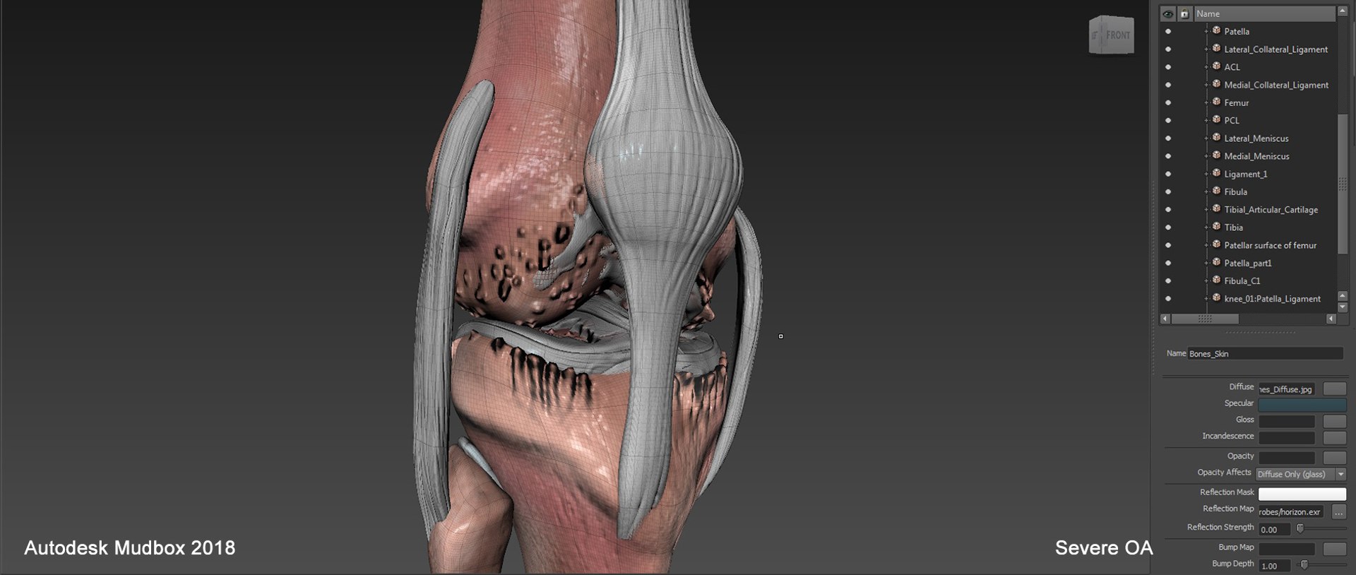 Osteoarthritis Severe Condition Knee 3D Model - TurboSquid 1410244