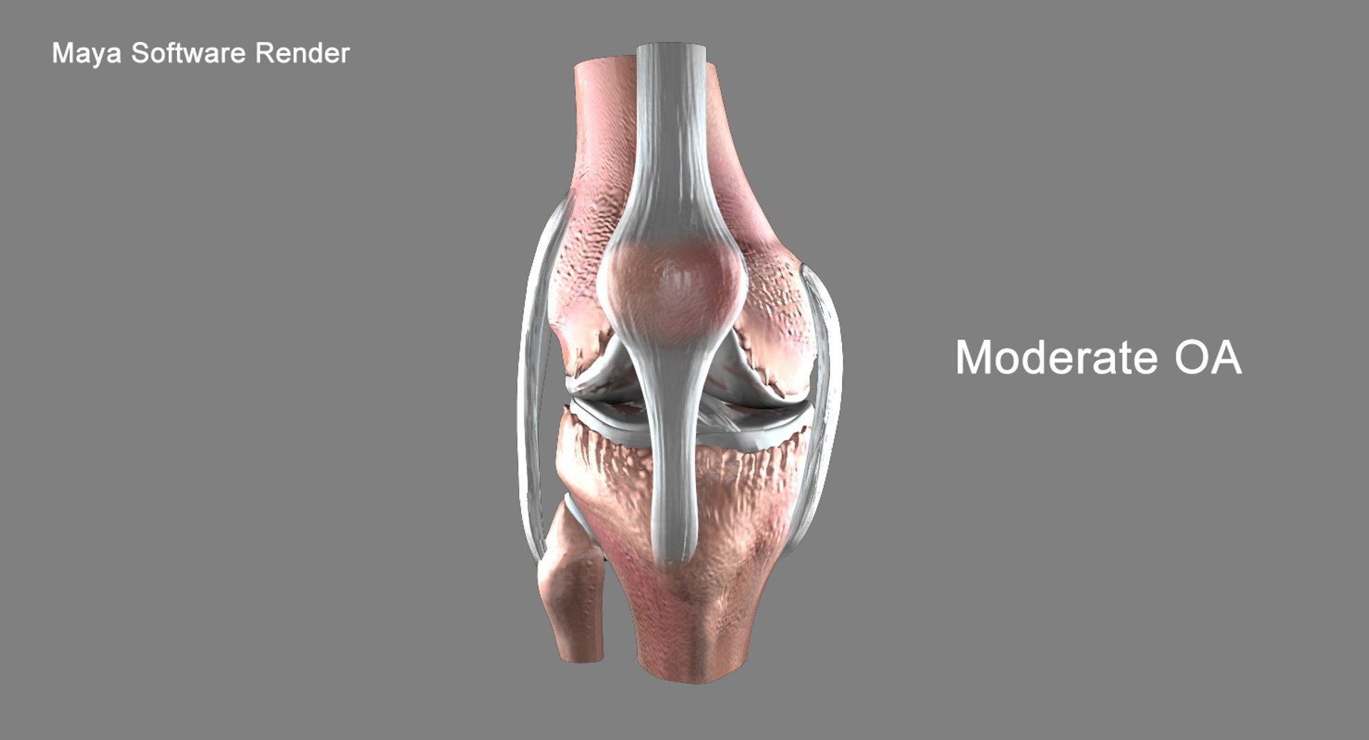 Osteoarthritis Severe Condition Knee 3D Model - TurboSquid 1410244