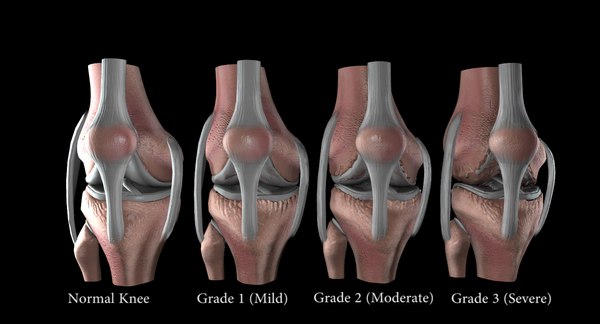 Osteoarthritis severe condition knee 3D model - TurboSquid 1410244
