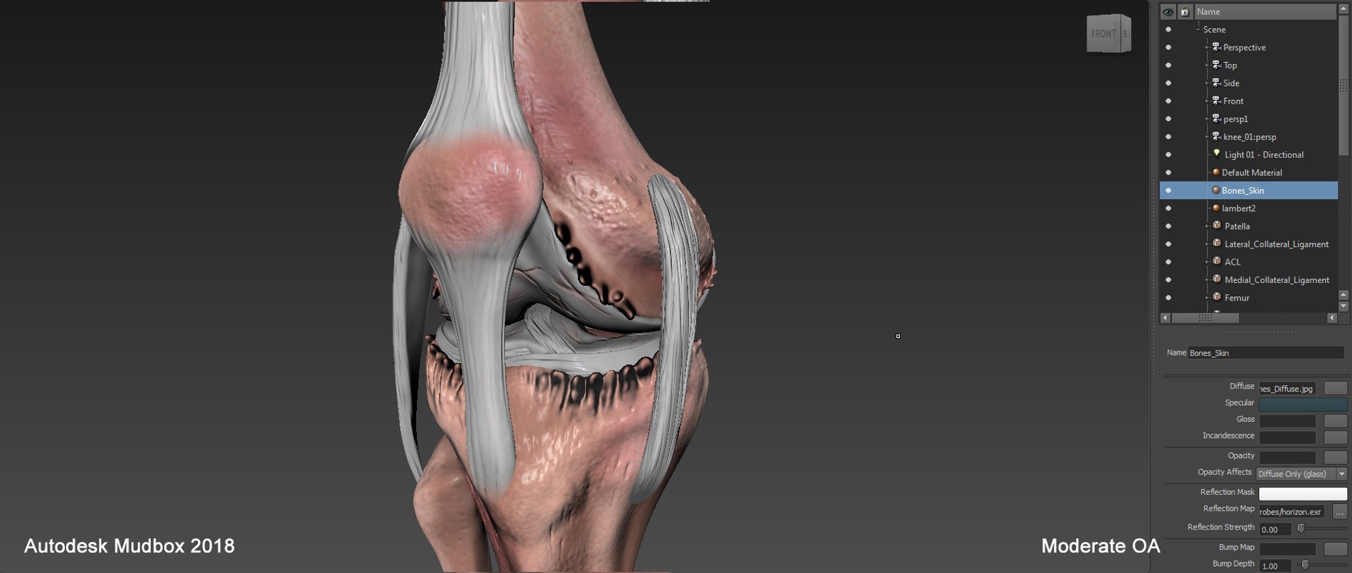 Osteoarthritis Severe Condition Knee 3D Model - TurboSquid 1410244