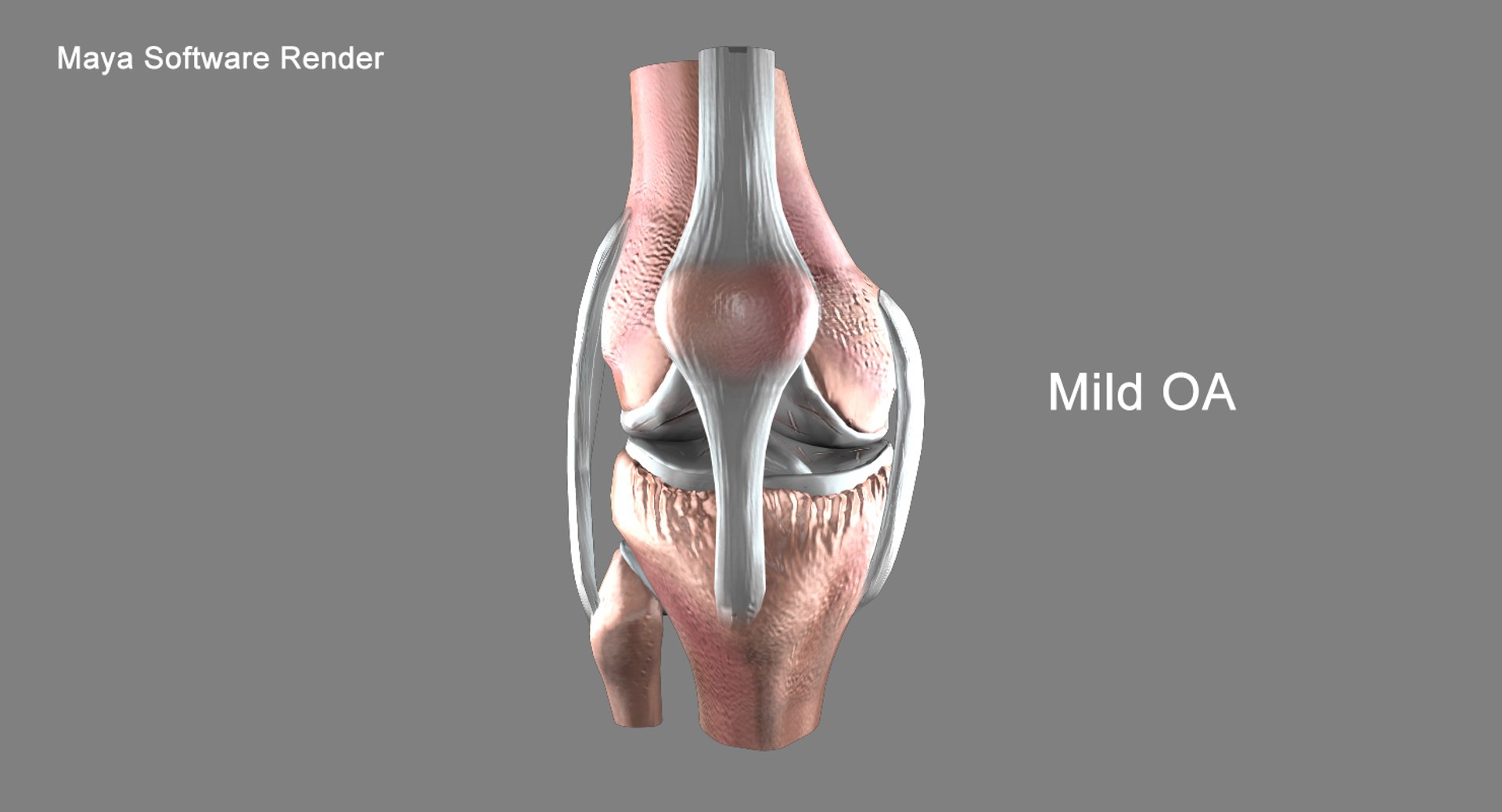 Osteoarthritis Severe Condition Knee 3D Model - TurboSquid 1410244