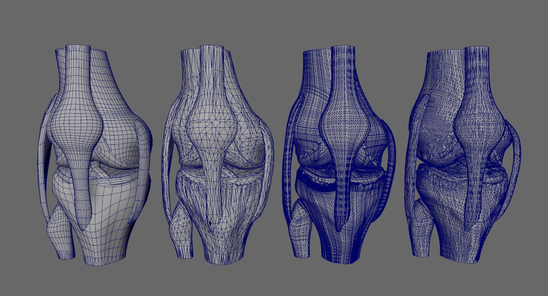 Osteoarthritis Severe Condition Knee 3D Model - TurboSquid 1410244