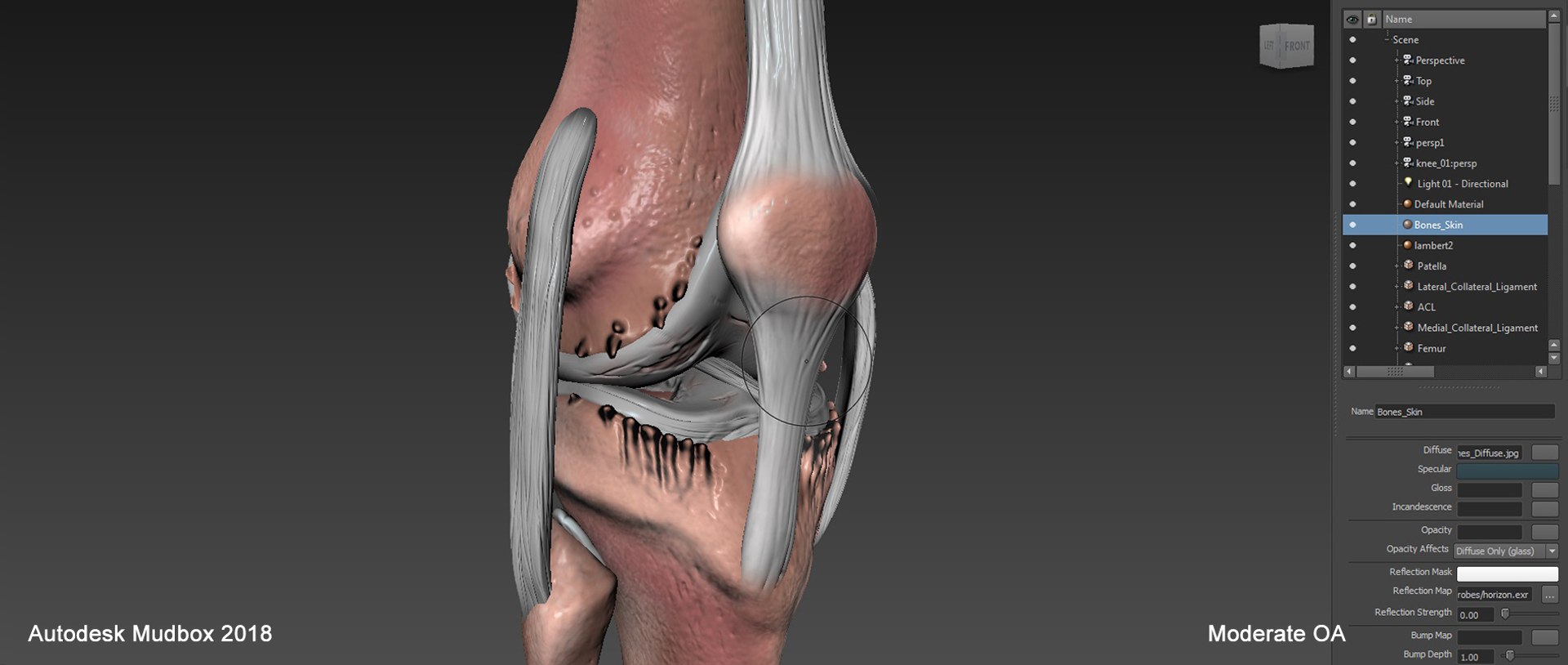 Osteoarthritis Severe Condition Knee 3D Model - TurboSquid 1410244