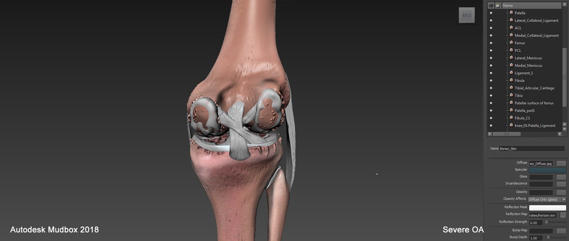 Osteoarthritis Severe Condition Knee 3D Model - TurboSquid 1410244