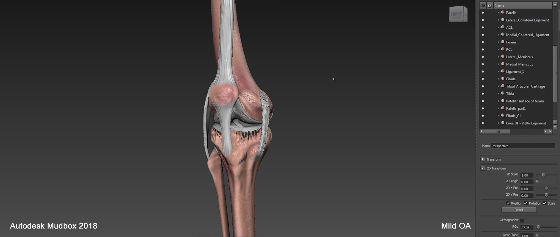 Osteoarthritis Severe Condition Knee 3D Model - TurboSquid 1410244