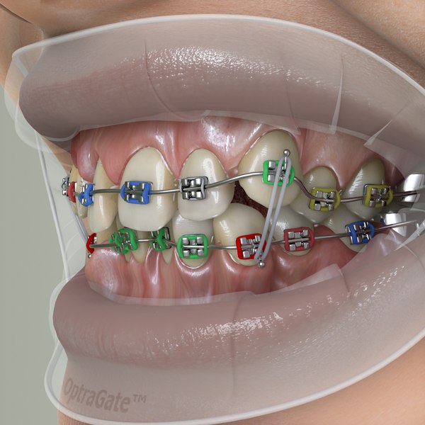 3d female orthodontic teeth face