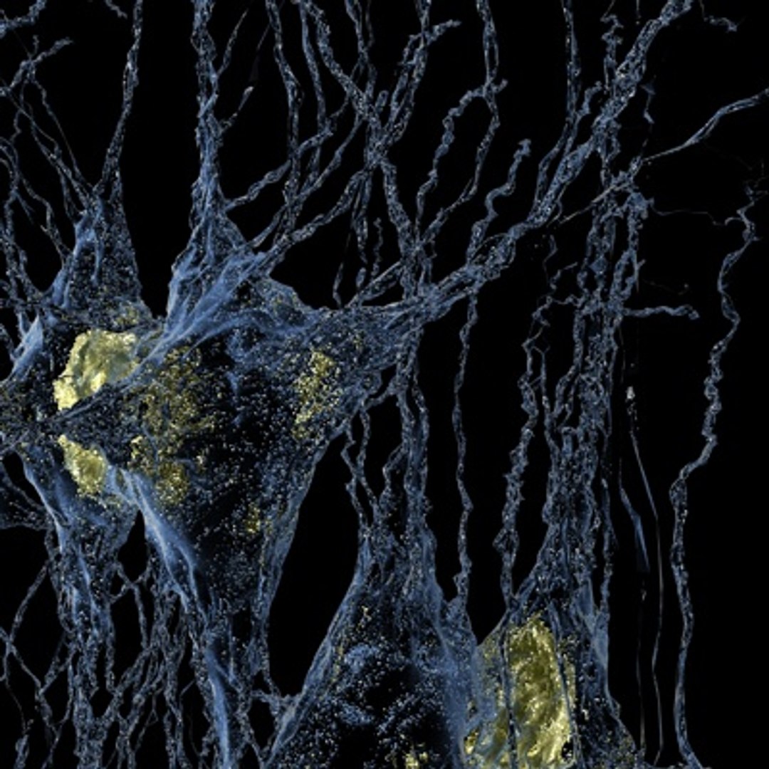 Brain Tumor 3d Model