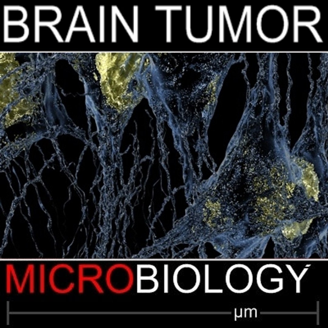 Brain Tumor 3d Model