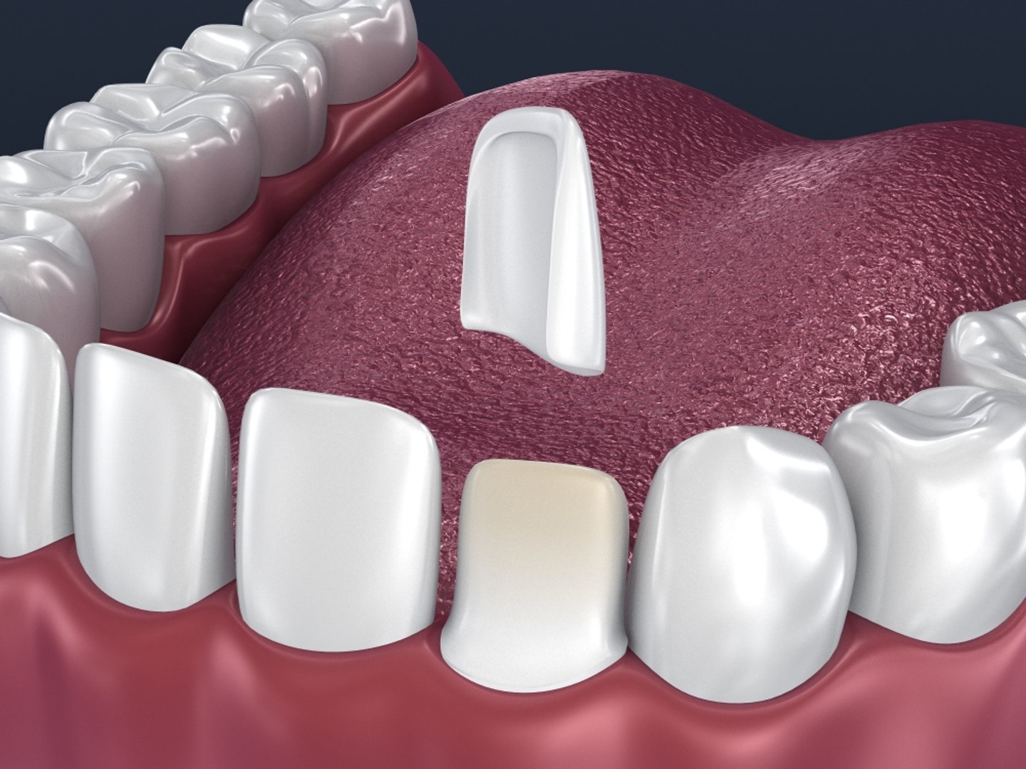 Dental Veneer Preparation Instalation 3D Model - TurboSquid 1339921