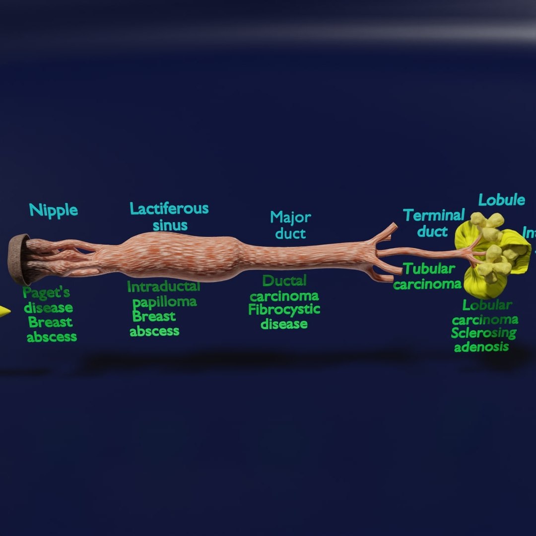 3D Breast Duct Sites And Diseases - TurboSquid 2112214