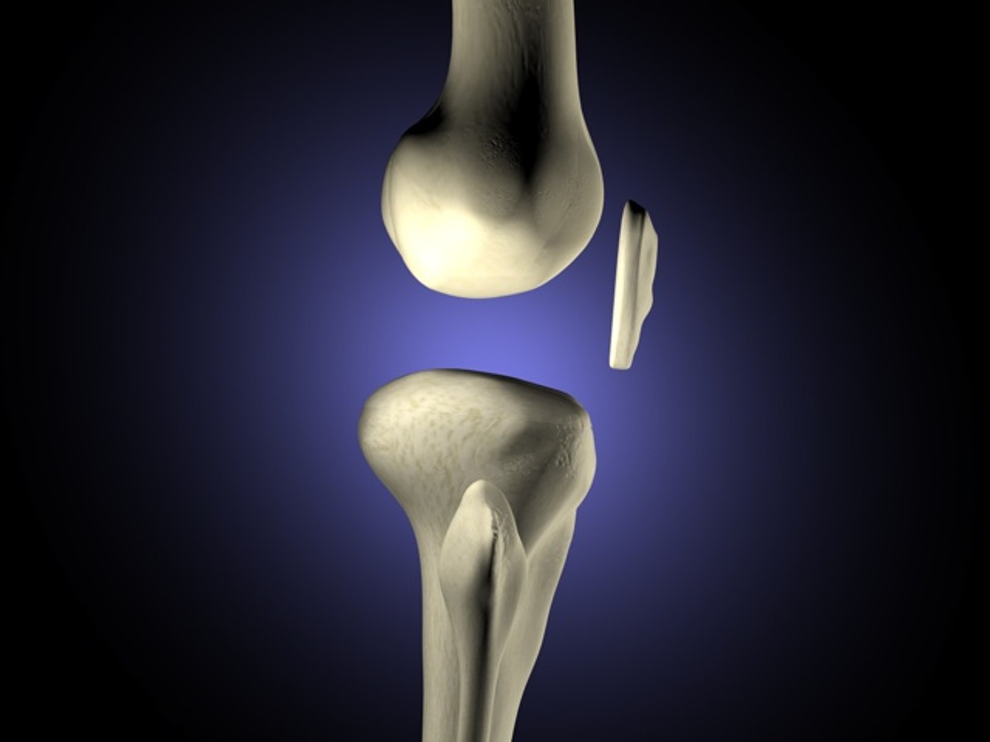 Knee Replacement 3d Model