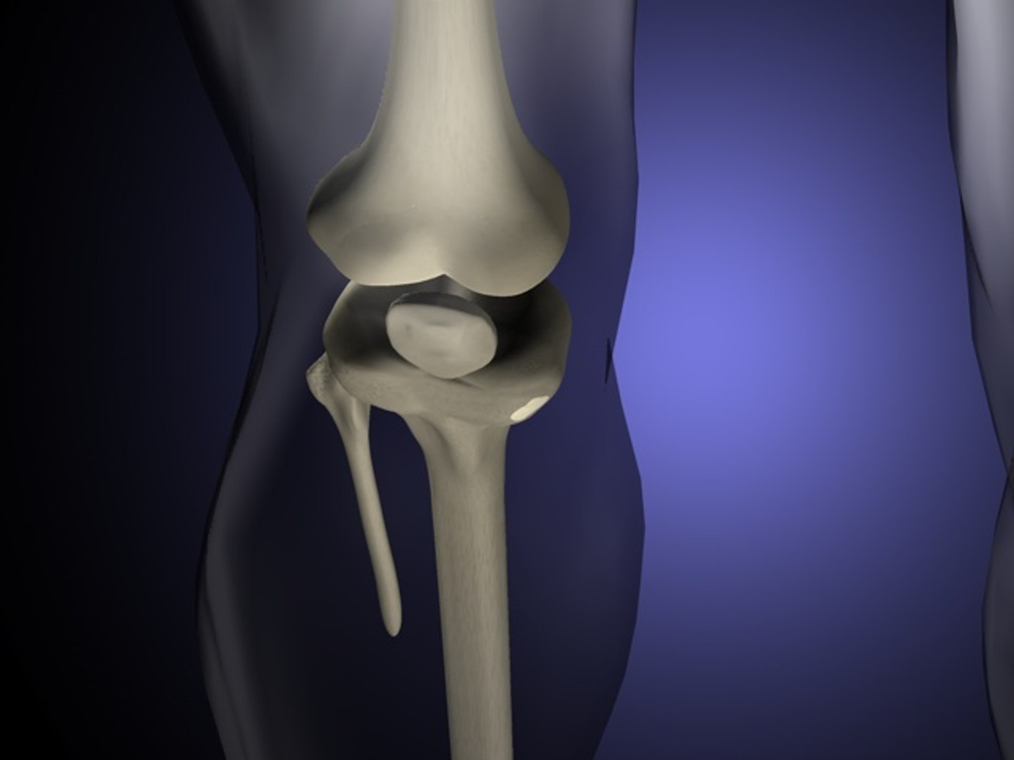Knee Replacement 3d Model