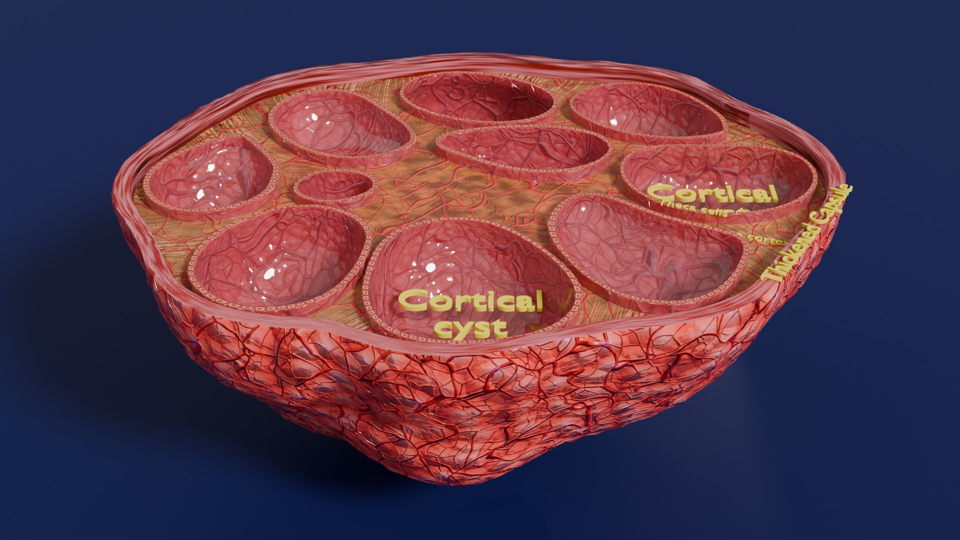 Polycystic Ovary Disease PCOD Model - TurboSquid 2296028