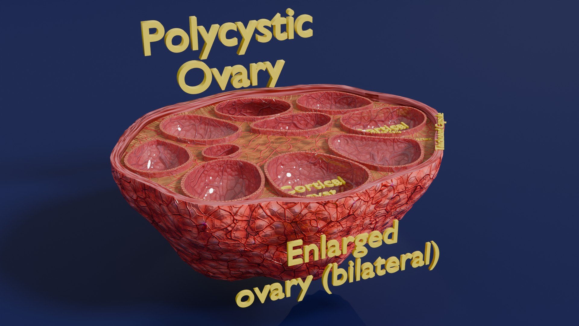 Polycystic Ovary Disease PCOD Model - TurboSquid 2296028