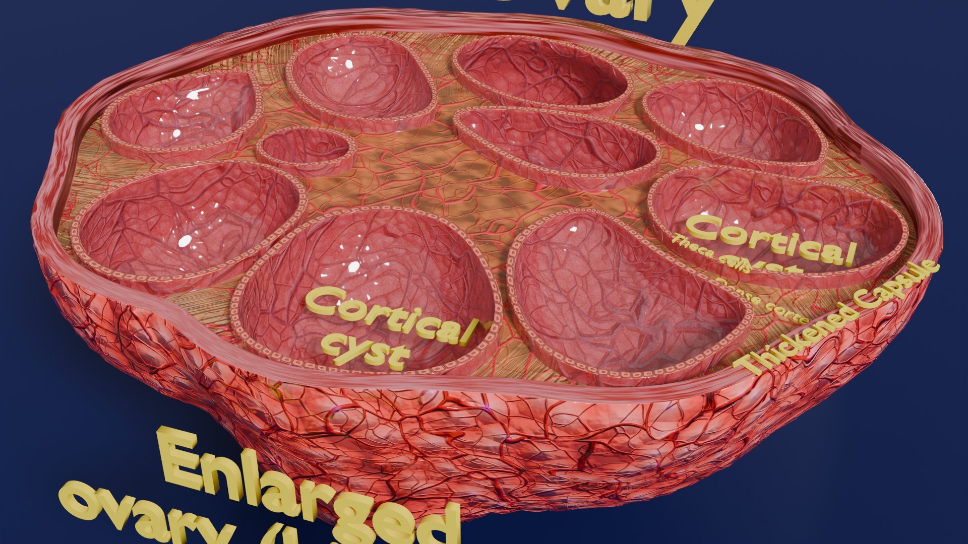Polycystic Ovary Disease PCOD Model - TurboSquid 2296028