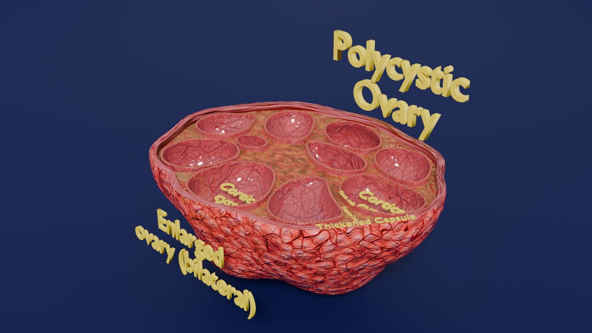 Polycystic Ovary Disease PCOD Model - TurboSquid 2296028