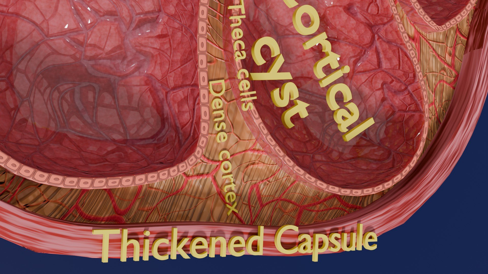 Polycystic Ovary Disease PCOD Model - TurboSquid 2296028